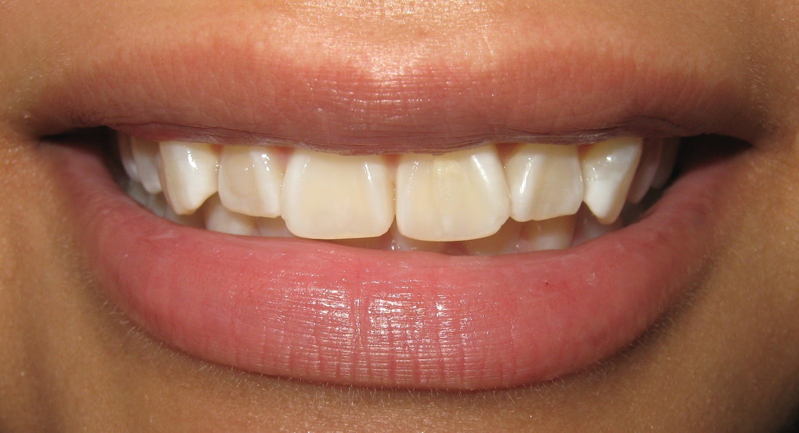 Br@ndy's Invisalign Journey: Tray 20!
