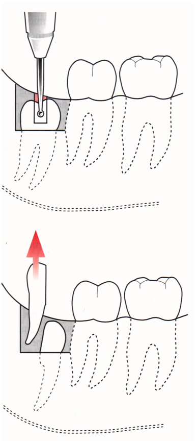 Dentistry and Medicine: Surgical management of Unerupted and Impacted teeth