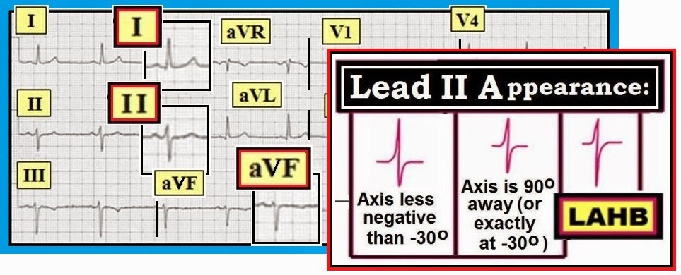 ECG Interpretation: ECG Blog #90 (Basic Concepts-3) – AXIS