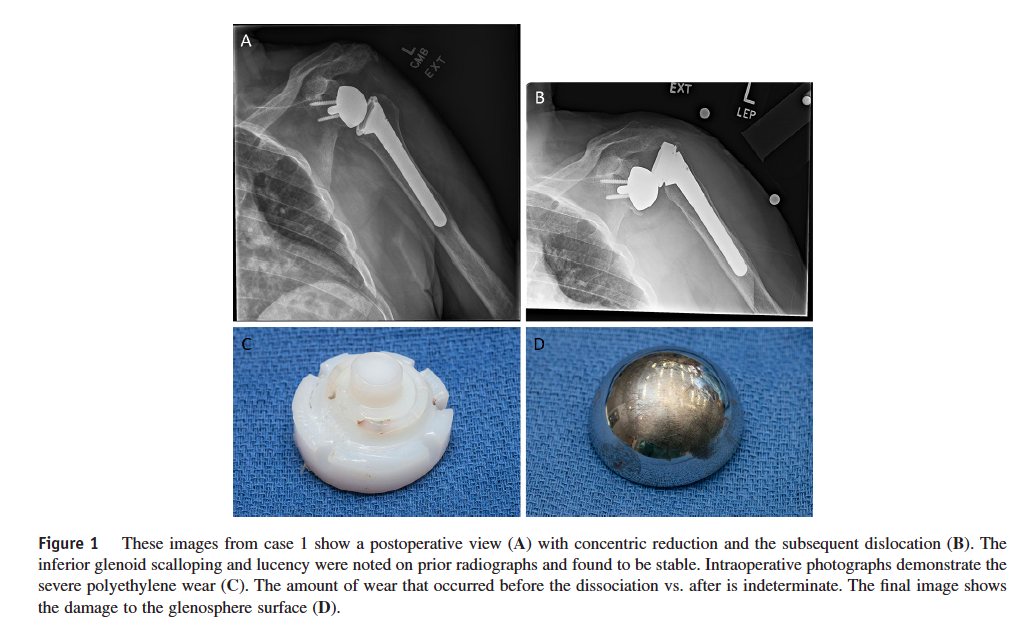 UW Shoulder and Elbow Academy: Reverse total shoulder - failure by ...
