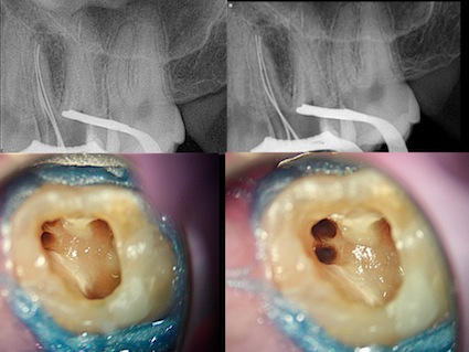 EQUIPE DE ENDODONTIA DE CAMPINAS: Locating the MB2 Canal in a Maxillary ...