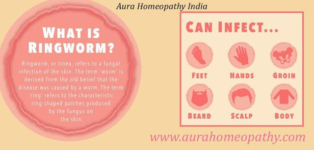 Homeopathy Best For Ringworm I Daad I Mycosis I Tinea Cruris I Jock ...