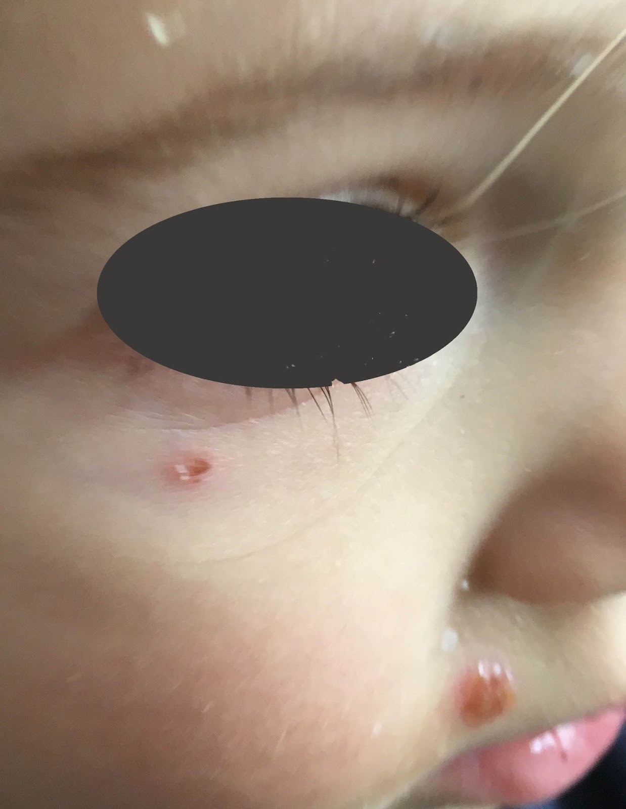 VIRTUAL GRAND ROUNDS IN DERMATOLOGY 2.0: Two year-old with enanthem and ...