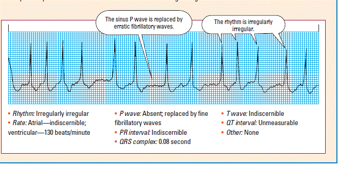 Atrial fibrilation (fibrilasi atrium, gangguan irama atrium)