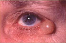 Conseils traitement des kystes sébacés - Articles à propos de la santé