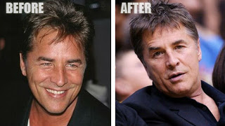 Don Johnson Plastic Surgery Before and After Facelift, Nose Job and ...