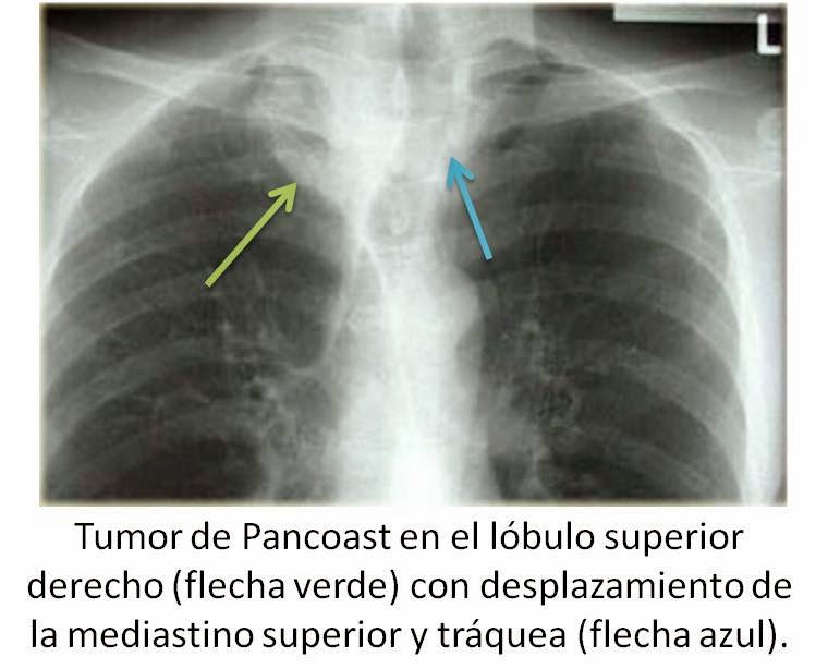 ESPE 203-2013: Caso clínico: tumor de Pancoast
