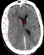 Dr Herry Setya Yudha Utama SpB. FInaCS. MHKes. ICS: Seri Bedah Saraf ...