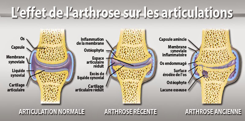Blog 75: Infos santé : Sport et Santé-Arthrose… une maladie cardio ...