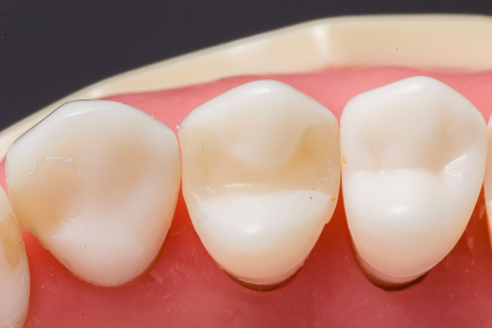 MOD Composite Preparation and Restoration 1: #14 MO Preparation #12 MOD ...