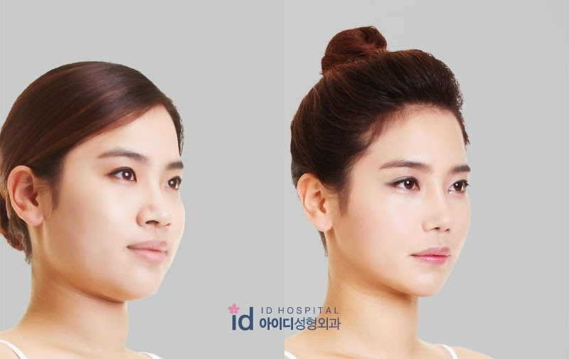 ID Hospital Korea: Advantage of Mini rhinoplasty
