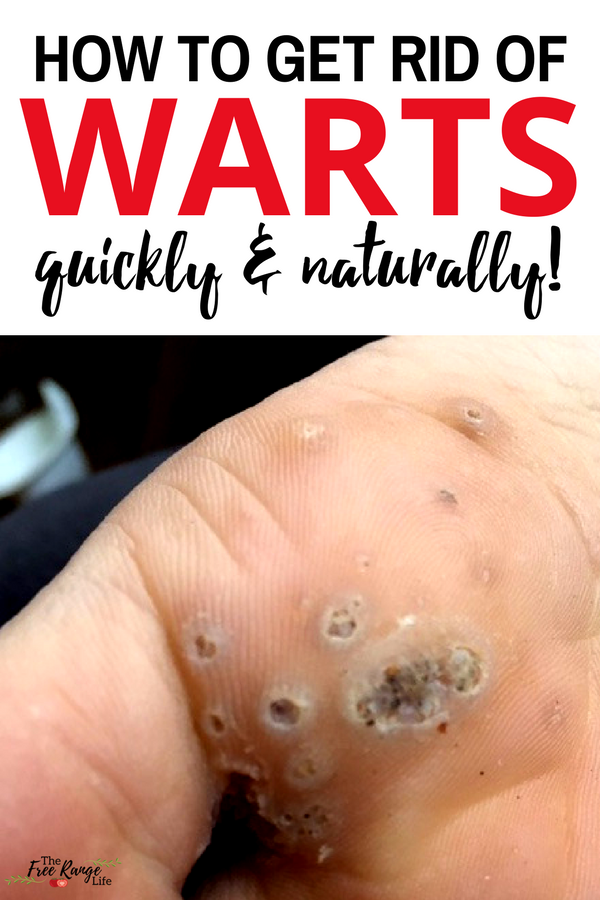 8 Best Home Remedies For Genital Warts Home Remedies
