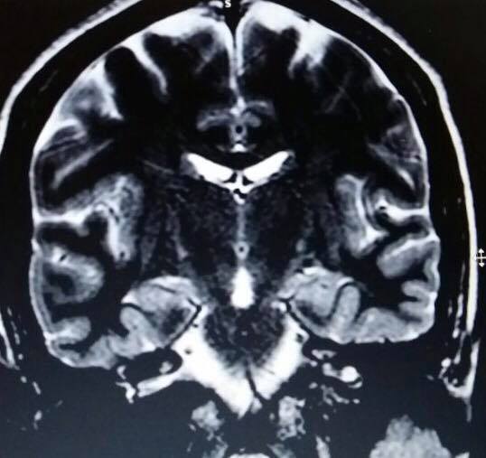 Amyotrophic lateral sclerosis: MRI - Sumer's Radiology Blog