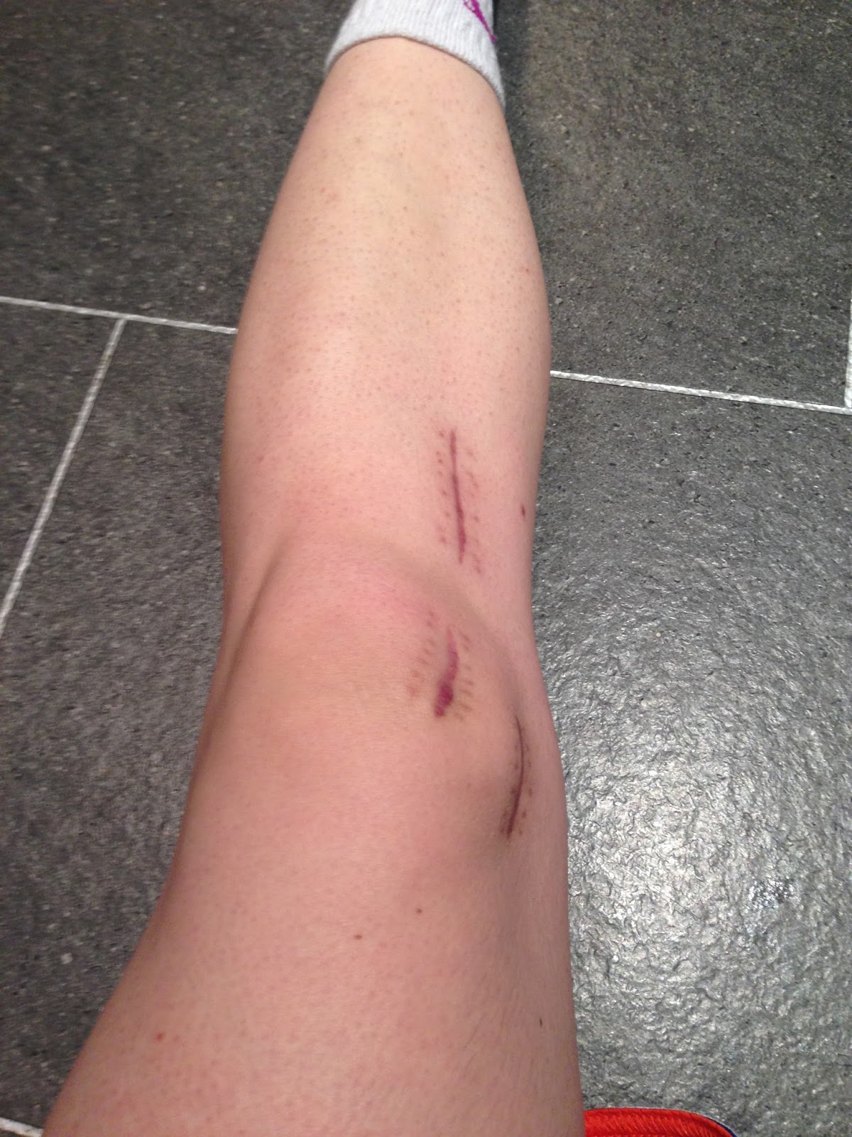 My Experience Having MPFL Reconstruction Surgery