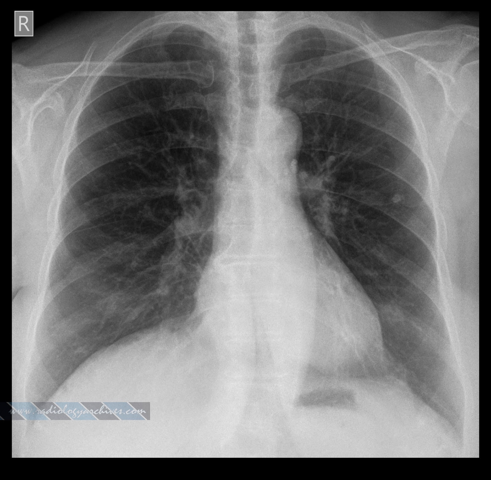 Radiology Archives: Πρωτοπαθές Σύμπλεγμα Φυματίωσης (Σύμπλεγμα Ranke)