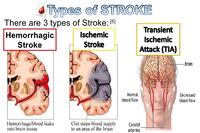 MY Health Venture: Cegah Angin Ahmar Kini Semudah ABC