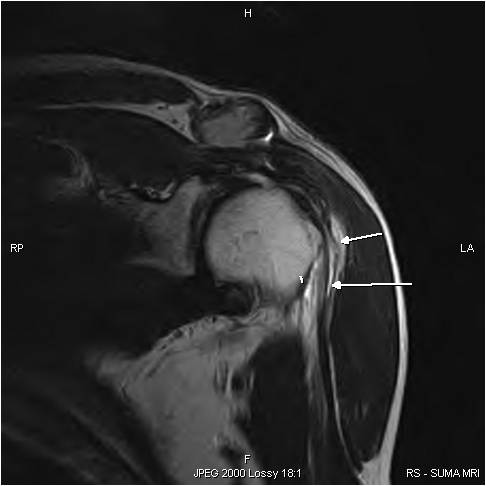 Long head of Biceps Rupture-MRI - Sumer's Radiology Blog