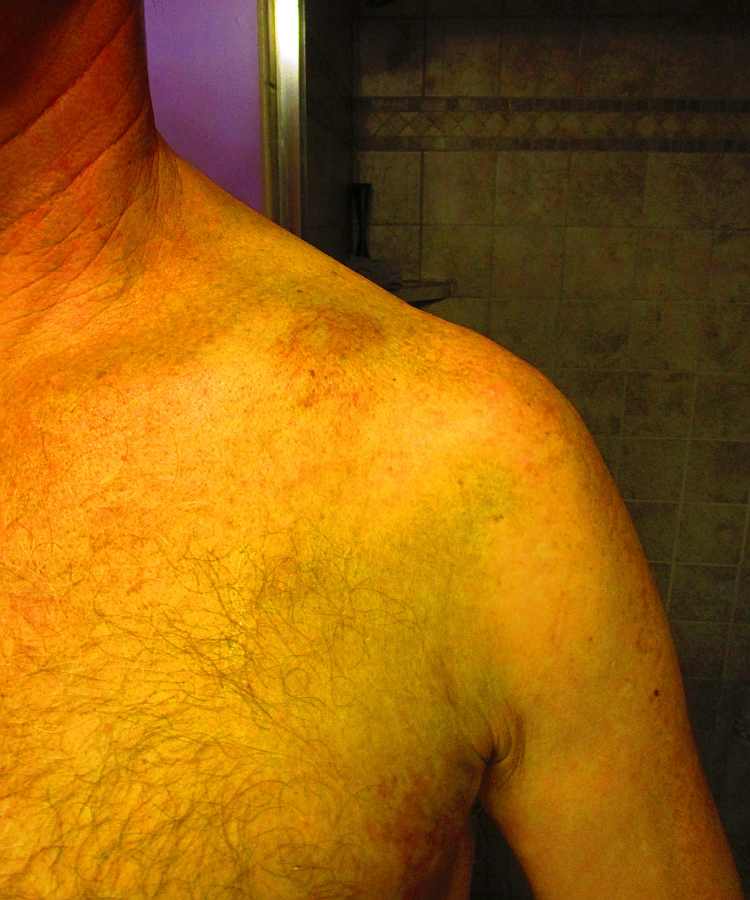 Life among the Tall Pines: Collarbone and bruising