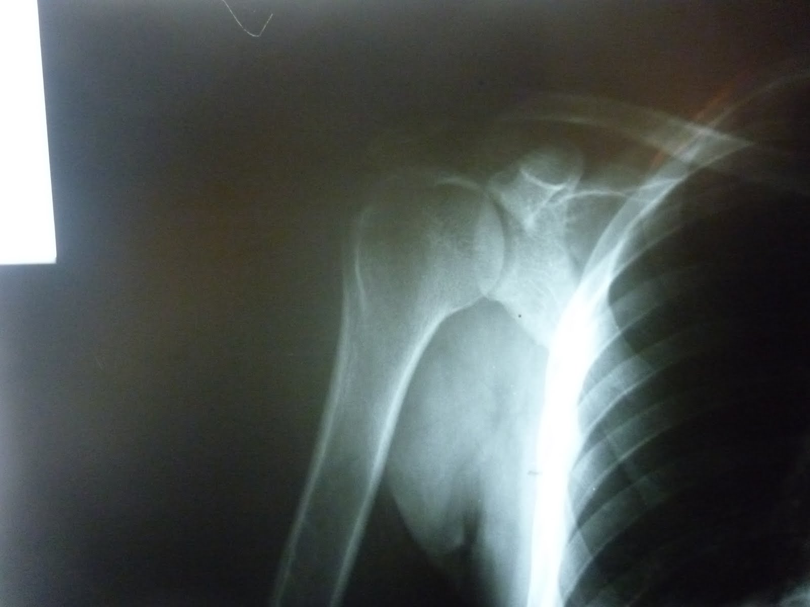 Rx011: Proyeccion Hombro