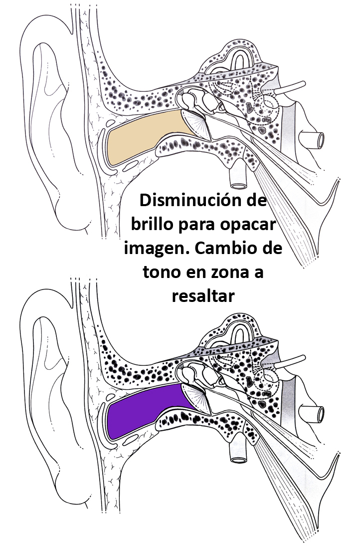 Canal Auditivo ~ La Oreja Sucia