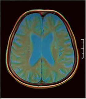 Nevit's blog: False-color Brain MRI (Motion artifacts)