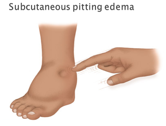 Why Do I Have Pitting Edema In My Shins