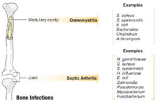 Bone and Joint infections ~ Zero-Infections