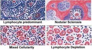 Limfoma Hodgkin ~ Informasi Kedokteran Dan Kesehatan