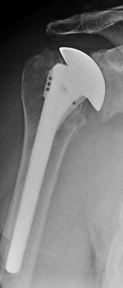 Shoulder Arthritis/Joint Replacement Rotator cuff tears: Simplicity in ...