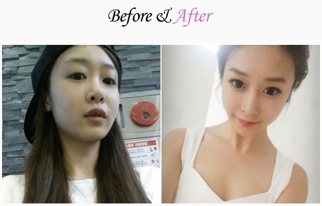 GNG Plastic Surgery Hospital: Real Story-Doctor Fixed My Awkward Nose ...