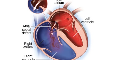 Why ASD Closure Surgery?