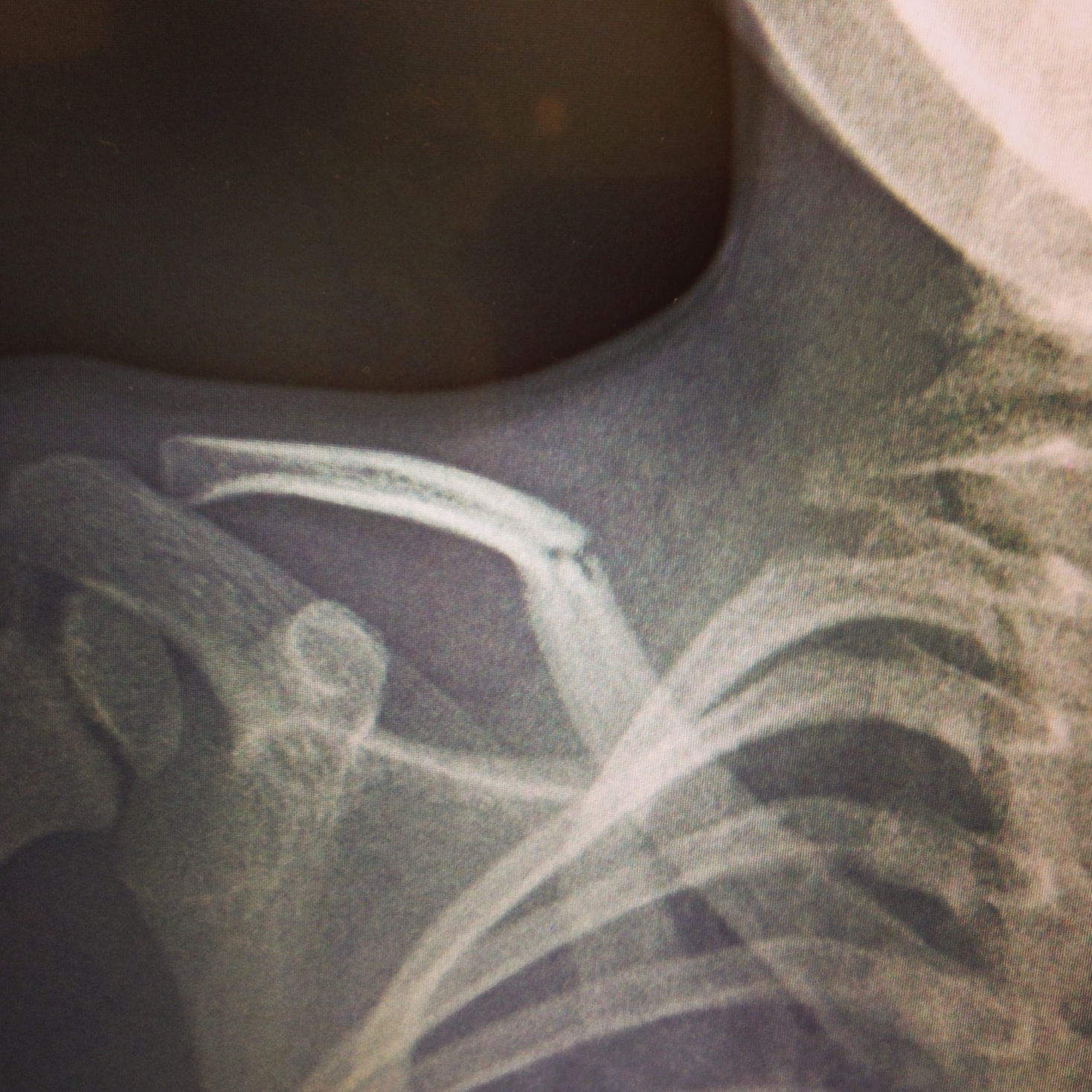 Allen Family: First Broken Bone