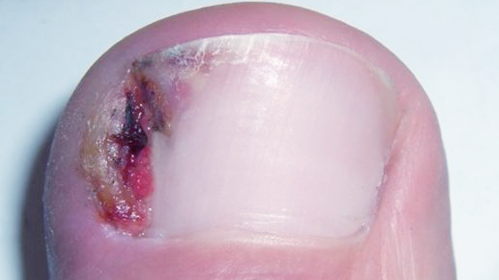 Ingrown Toenails - Nashville Podiatrists: The Nashville Foot and Ankle ...