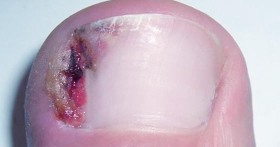 Nashville Podiatrists: The Nashville Foot and Ankle Group: Ingrown Toenails