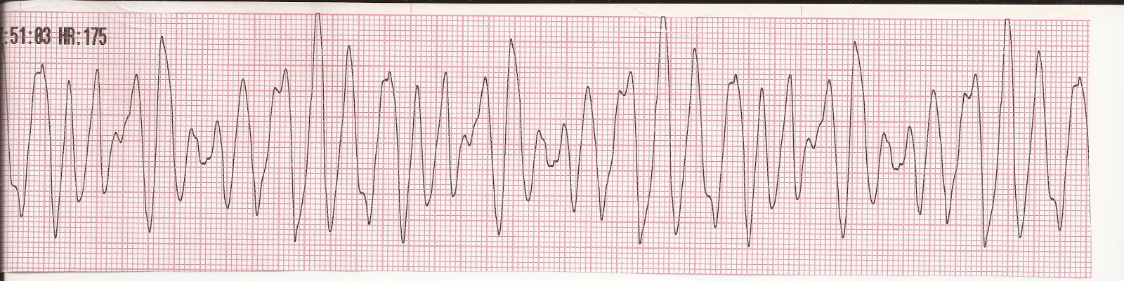 ACLS Rhythms: Ventricular rhythms