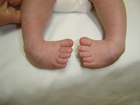 Vie Clínica de Fisioterapia: Artrogripose Múltipla Congênita