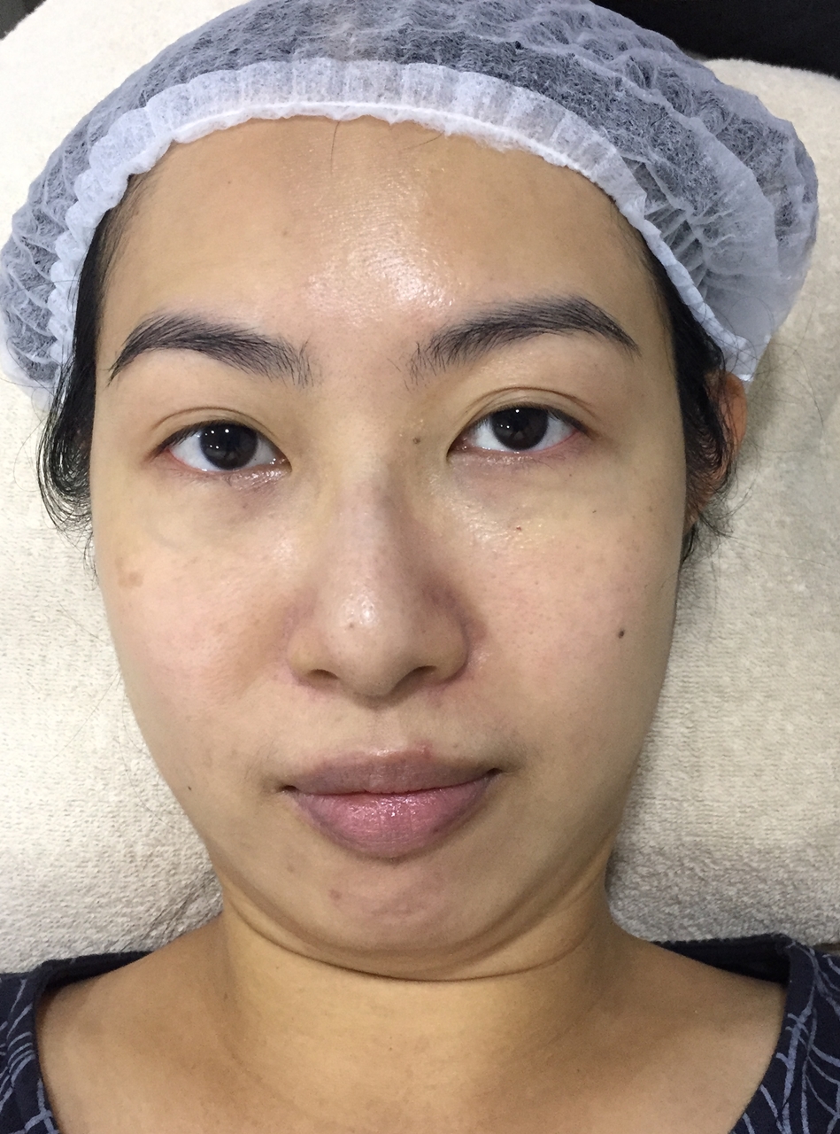 Wintyb 的瘋狂生活: Viora Reaction CORE 提升面型輪廓療程