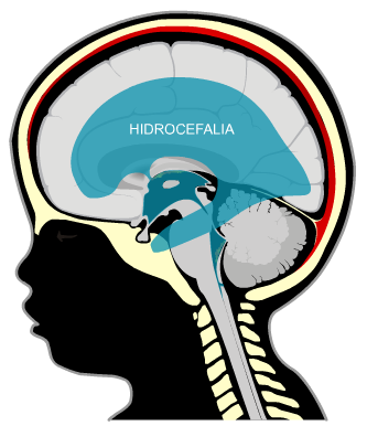Fisioterapia: Resumo hidrocefalia