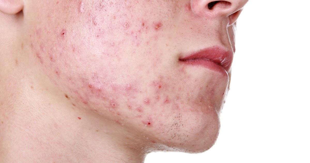 Hilangkan Parut Dan Jerawat Batu Di Muka Dengan Set Bajet Student ...