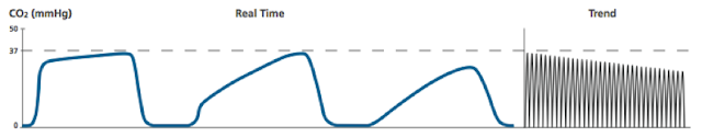 EM Didactic: Capnography beyond ROSC
