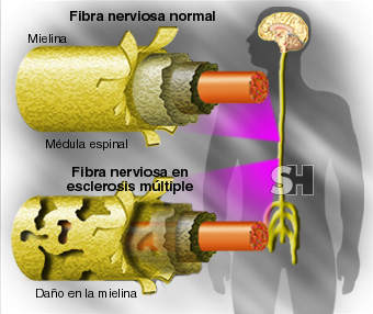 Esclerosis Multiple: Esclerosis Múltiple
