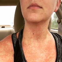 Melanoma and Mimosas