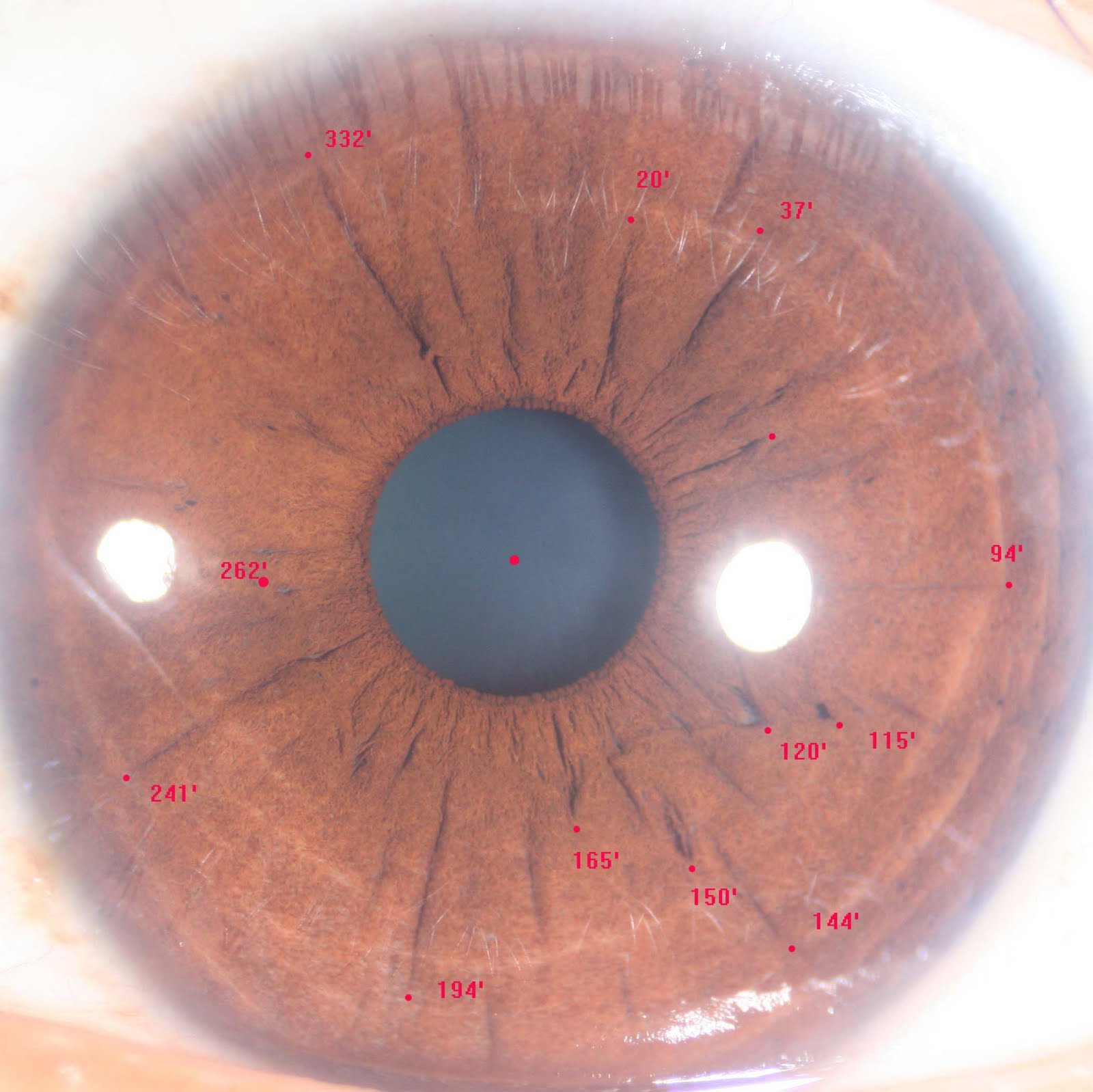 Modern & Multidimensional Iridology: Intersaction of Radial ...