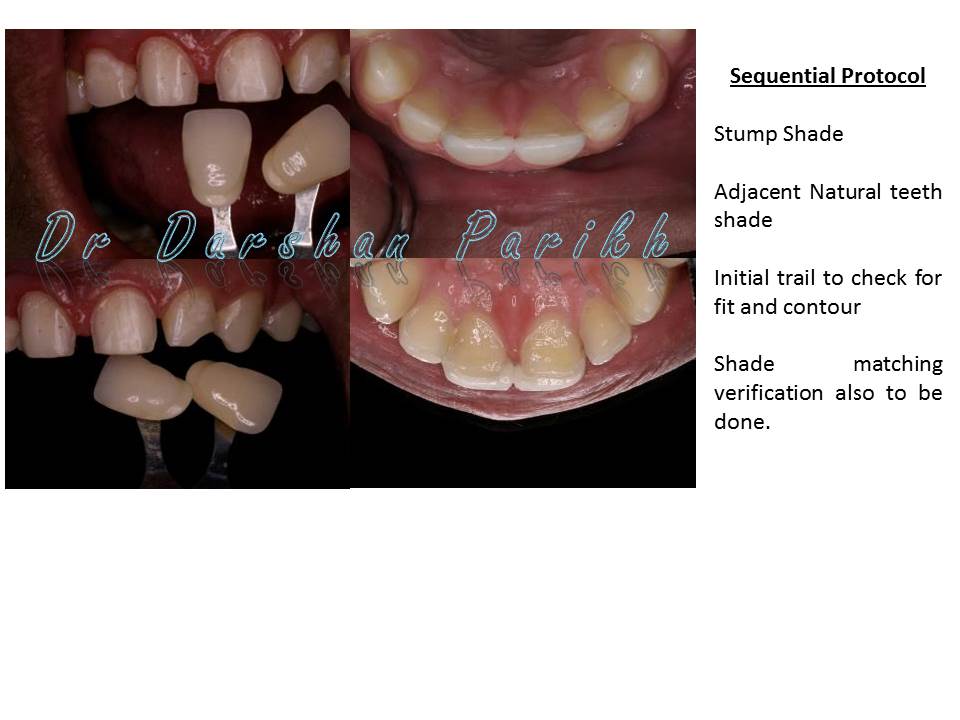 Gap Closure for Upper Front Teeth