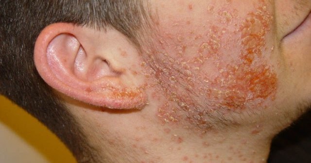 Staph infection on neck
