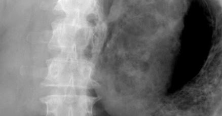 Emphysematous pyelonephritis - Review