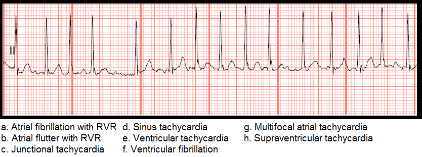 Fast Heart Rhythm Quiz 295