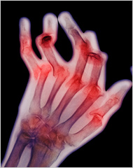 YANG PERLU ANDA KETAHUI MENGENAI PENYAKIT REMATIK ~ INFO KESEHATAN KITA