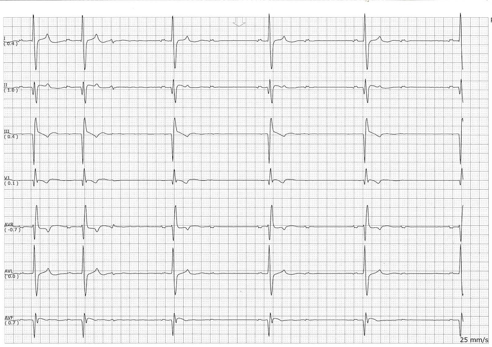 Second degree Type I changing to second degree type II