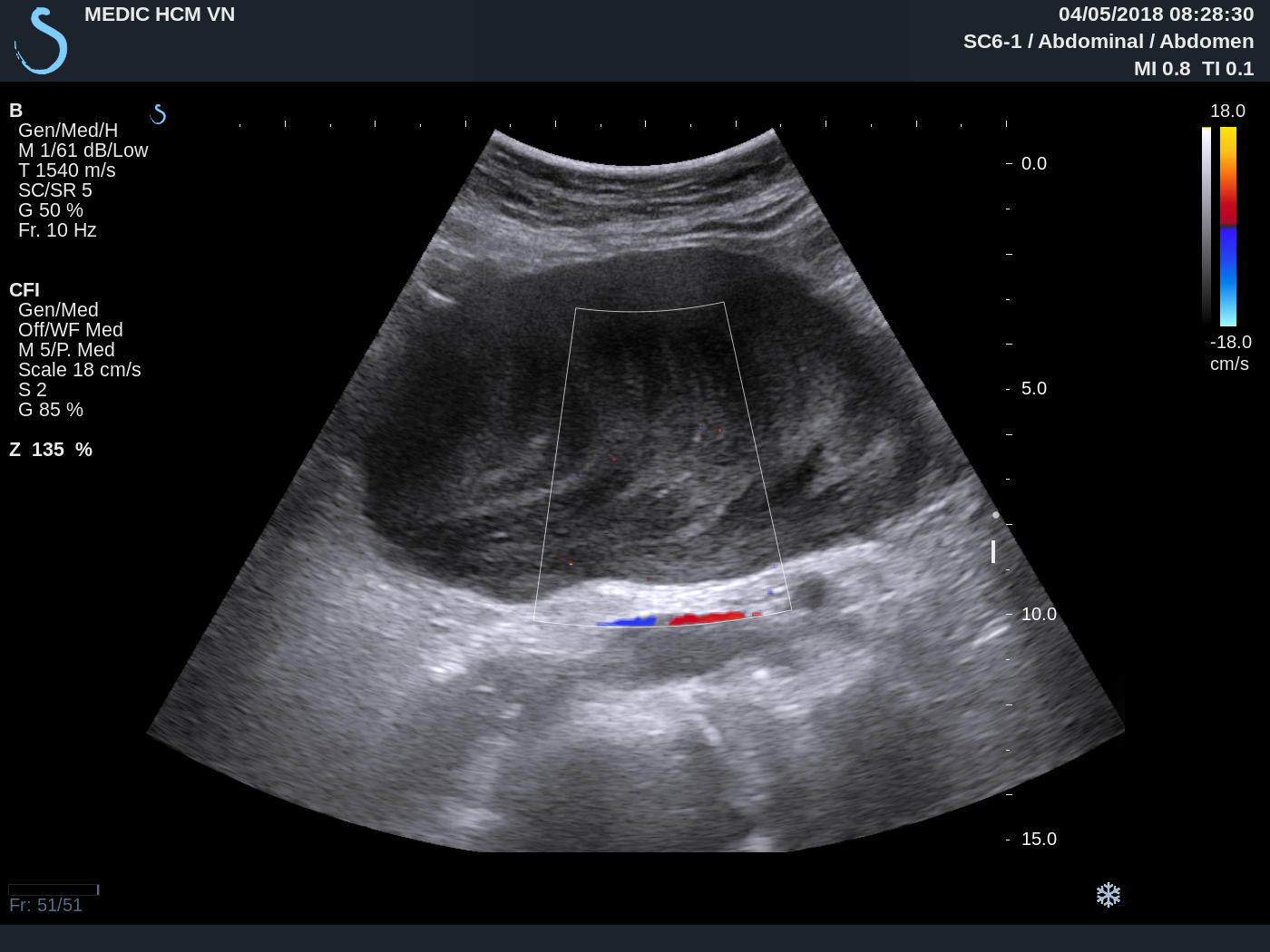 VIETNAMESE MEDIC ULTRASOUND: CASE 492 : APPENDICULAR MUCOCELE, Dr PHAN ...